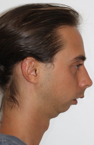 Principais diferenças entre prognatismo e retrognatismo