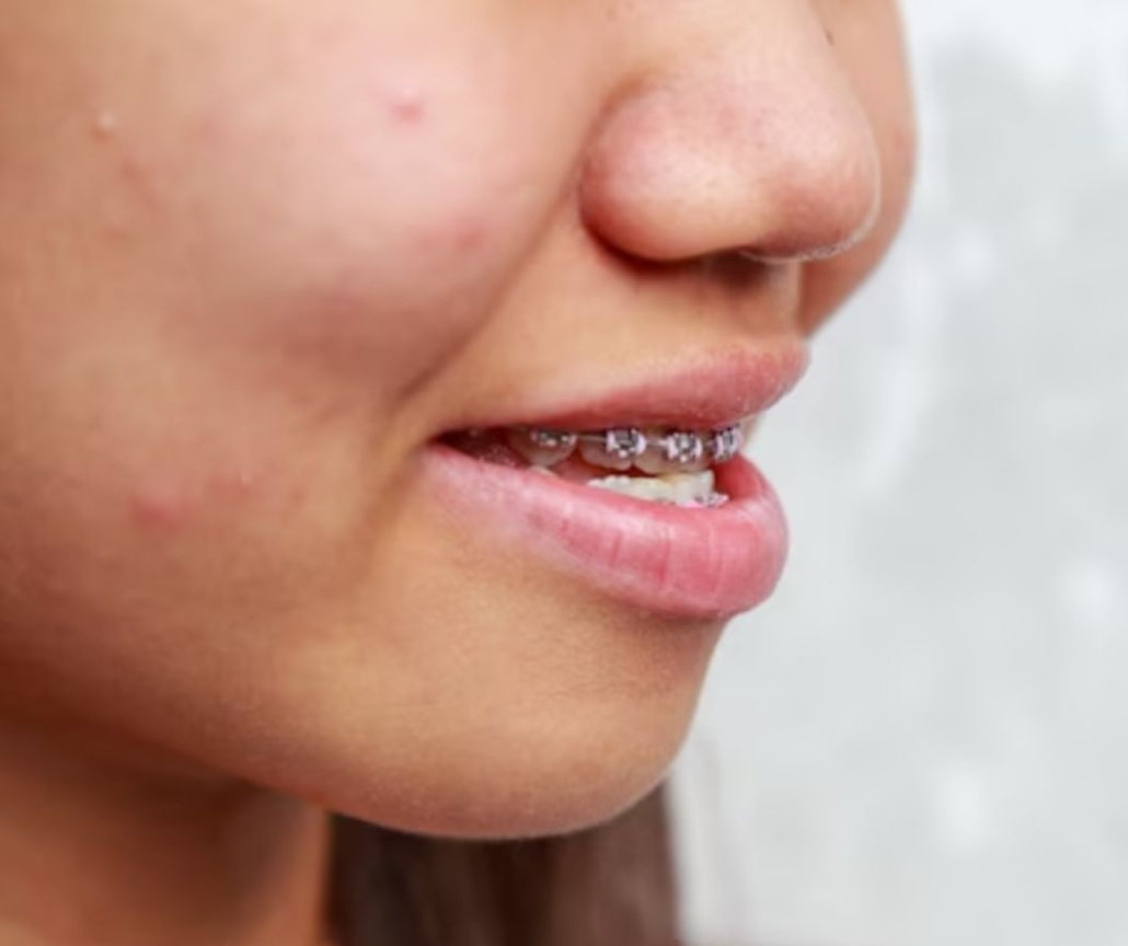 Principais diferenças entre prognatismo e retrognatismo